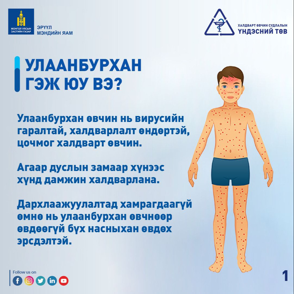 Сэрэмжлүүлэг Баян Өлгий аймагт улаанбурхан өвчний сэжигтэй тохиолдол